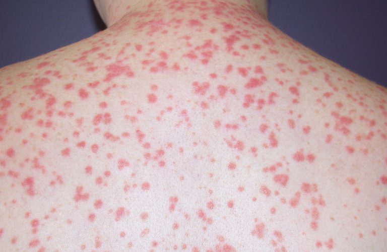 Psoriasis | Causes, Triggers, Diagnosis & Treatment