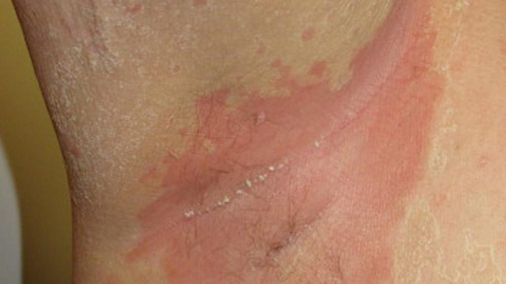 Psoriasis | Causes, Triggers, Diagnosis & Treatment